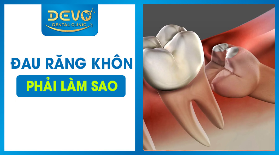 Đau răng khôn, răng số 8 phải làm thế nào? Cách giảm đau nhanh
